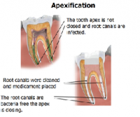 Apexogenesis & Apexification - Endodontic Associates Toronto