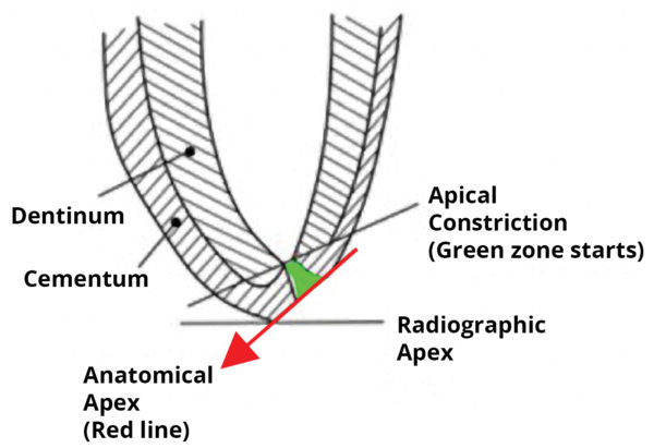 Where Is the End of the Apex? - Endodontic Associates