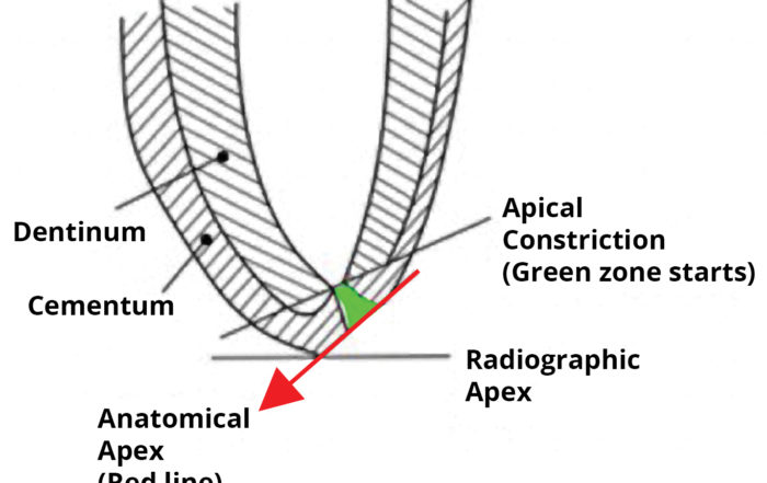 radiographic apex Archives - Endodontic Associates
